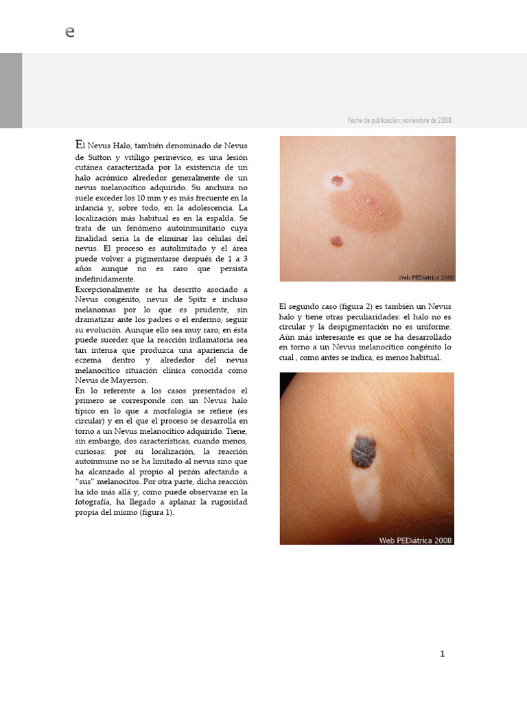 Nevus Halo: Características y Casos Clínicos | PDF | Melanoma ...