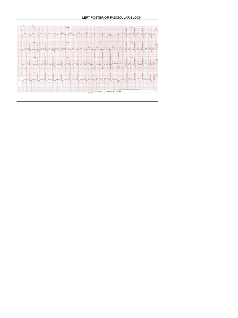 Left Posterior Fascicular Block | PDF