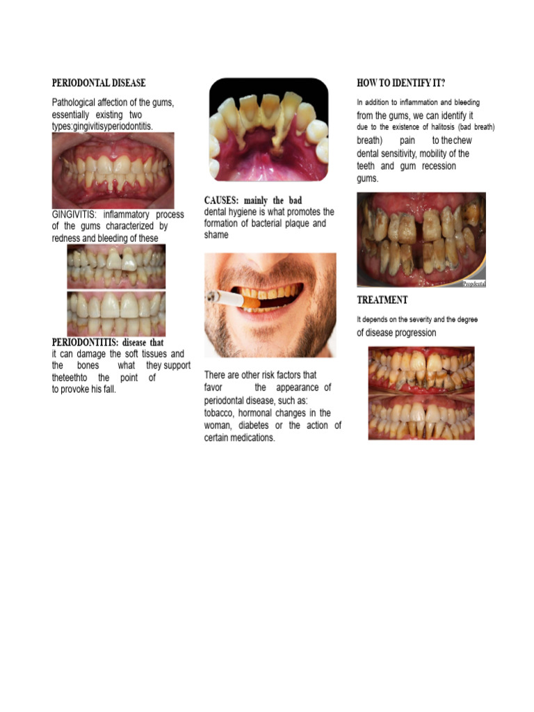 PERIODONTAL DISEASE Tri-Fold | PDF | Periodontology | Oral Hygiene