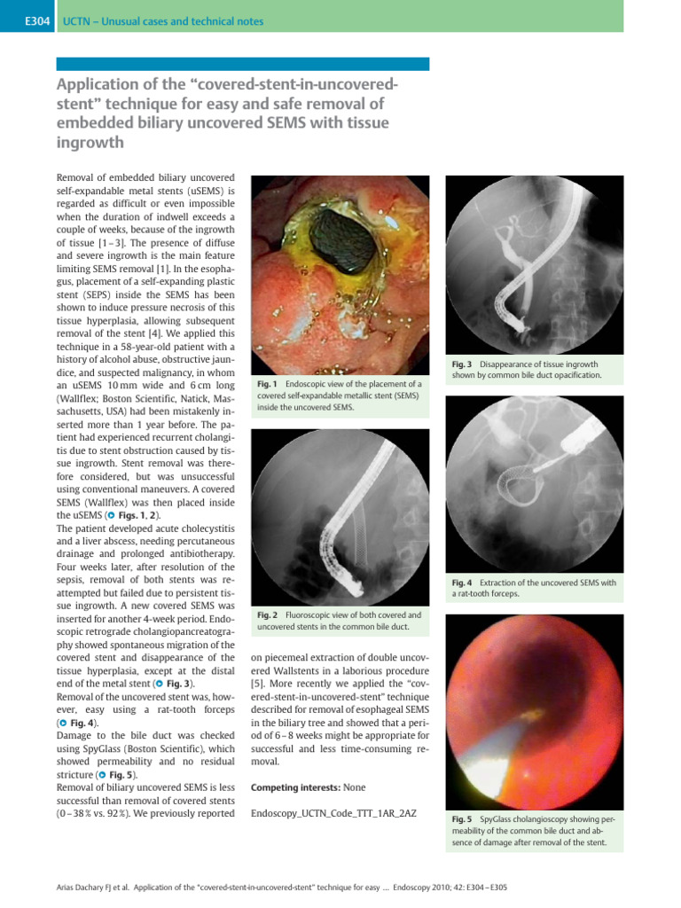 Biliary Stent Removal Technique Explained | PDF | Stent | Clinical Medicine
