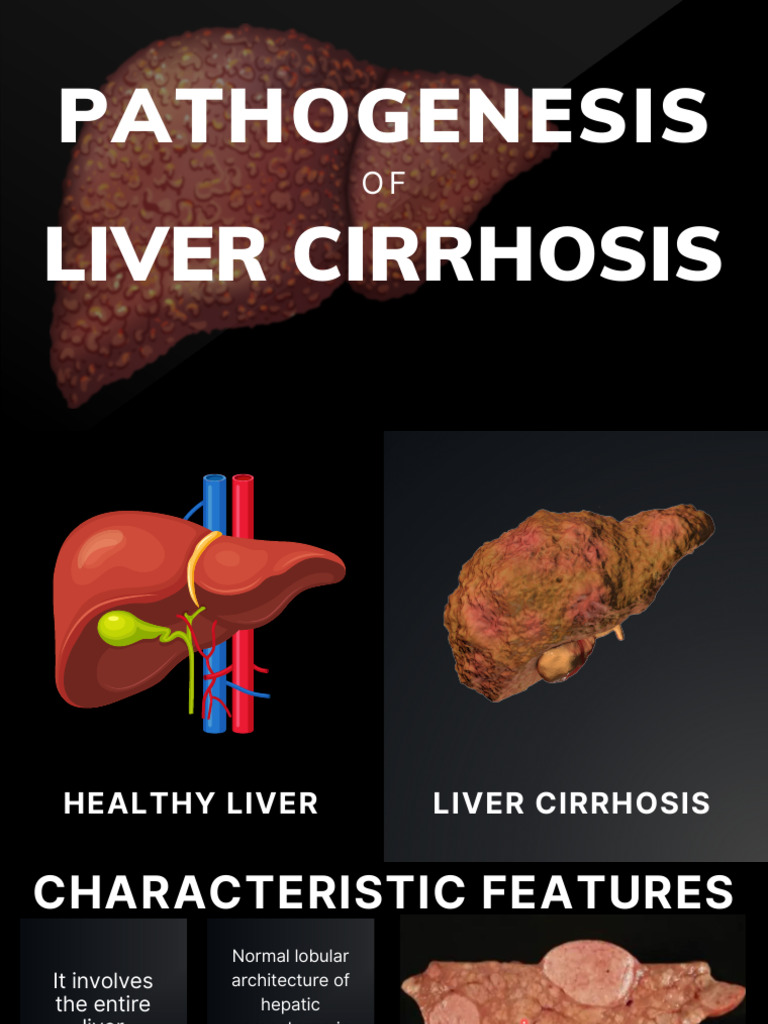 Pathogenesis of Liver Scerosis | PDF | Liver | Cirrhosis