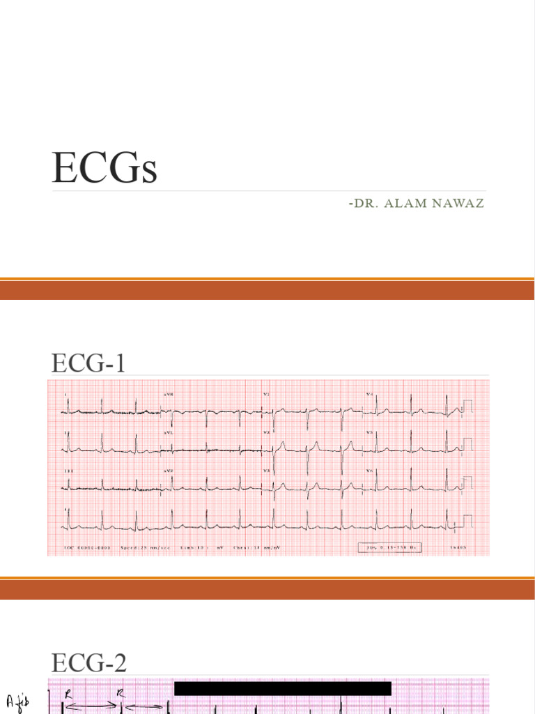 ECGs | PDF