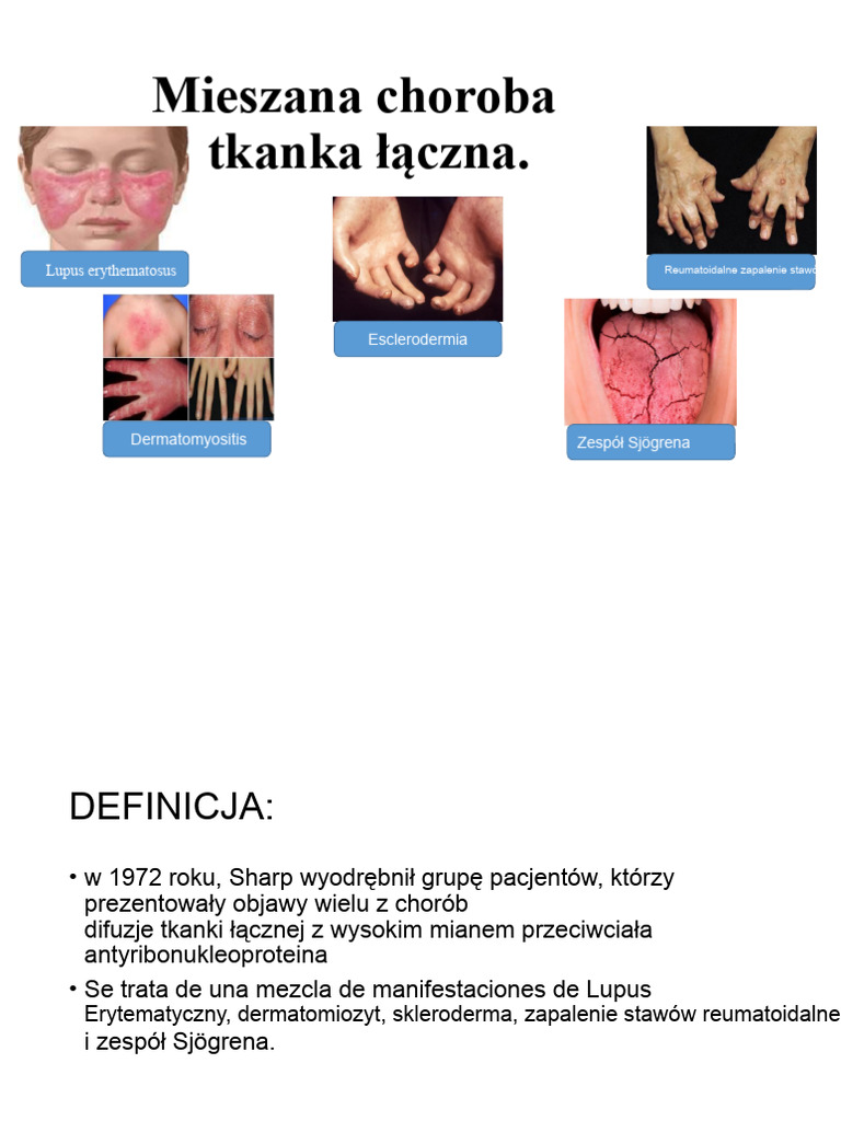 Mieszana choroba tkanki łącznej | PDF