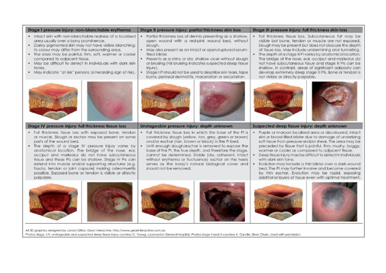 Pressure Injury Classification System | PDF
