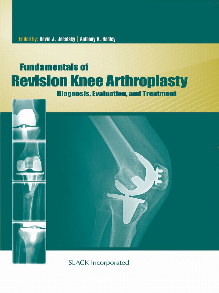 Revision Knee Arthroplasty Guide | PDF | Knee | Medical Specialties