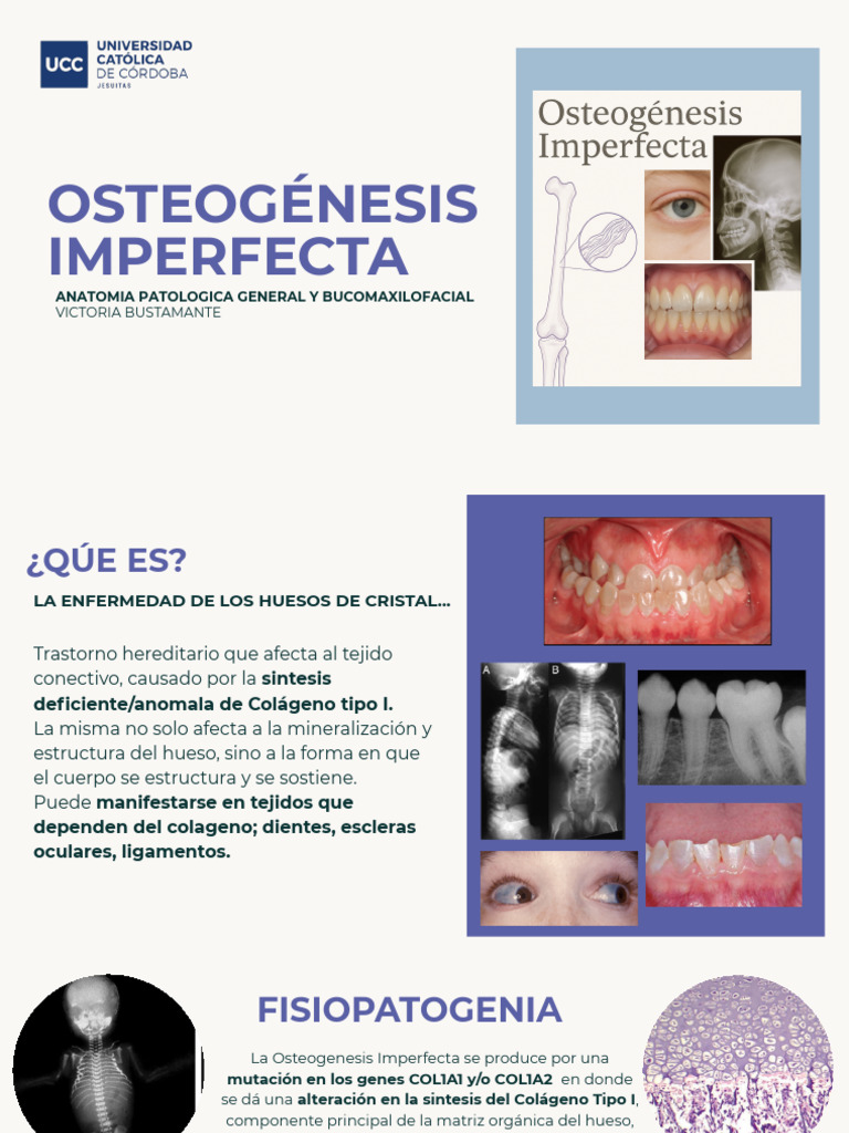 Osteogenésis Imperfecta 1 | PDF | Hueso | Enfermedades y trastornos
