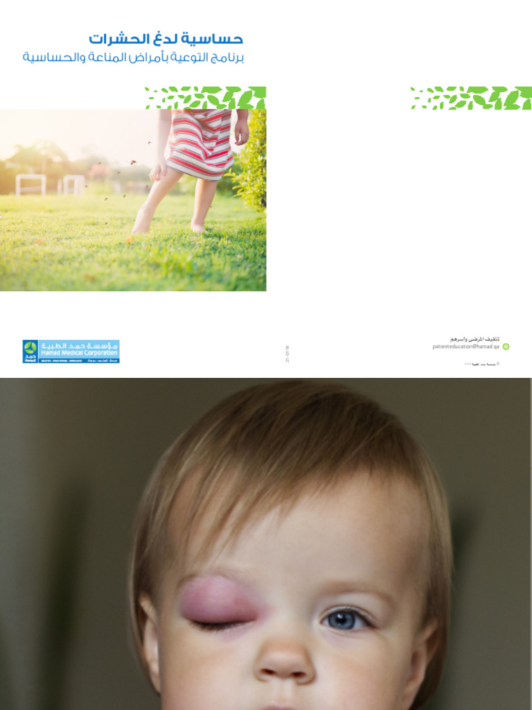 Insect Sting Allergy AR | PDF