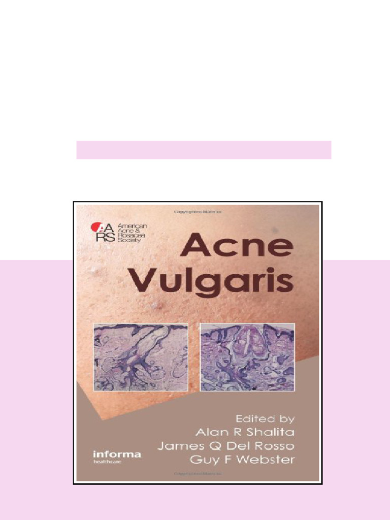 (Ebook) Acne Vulgaris by Alan R. Shalita, James Q. Del Rosso, Guy ...