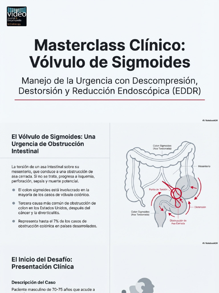 Vólvulo Sigmoides Descompresión Endoscópica | PDF