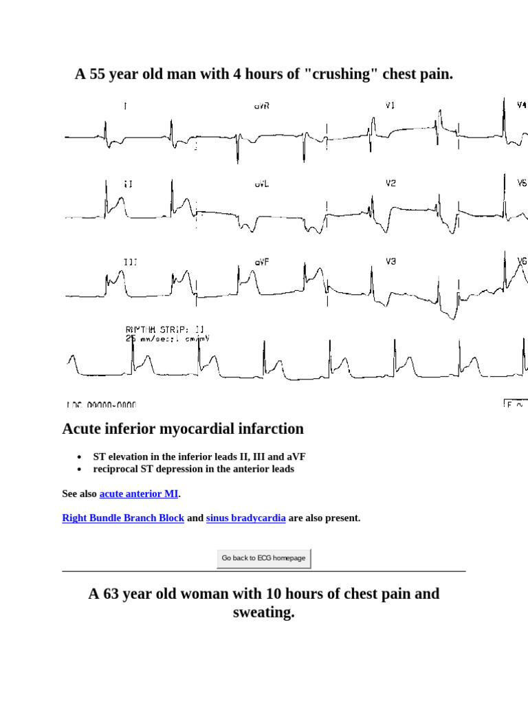 Myocardial Infarction ECG Findings | PDF | Electrocardiography ...