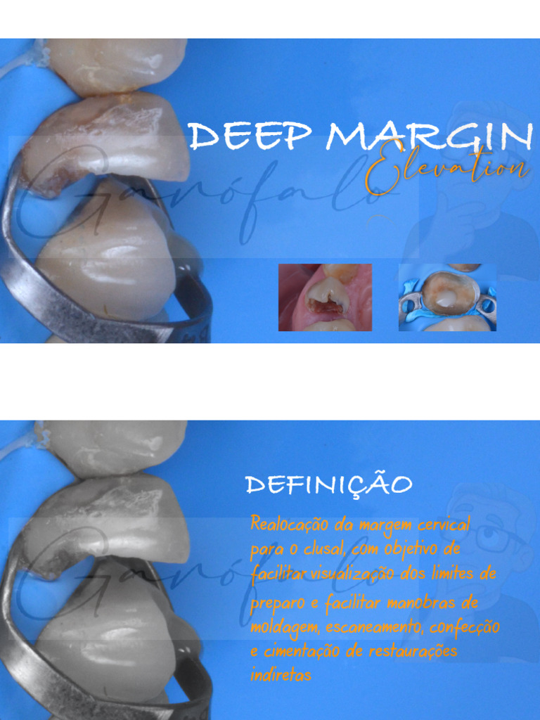 Deep Margin Elevation | PDF | Especialidades médicas