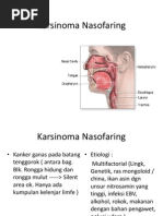 Karsinoma Nasofaring | PDF