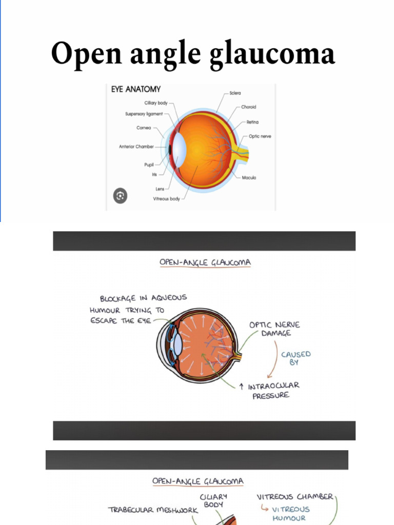 Open Angle Glaucoma 2 | PDF