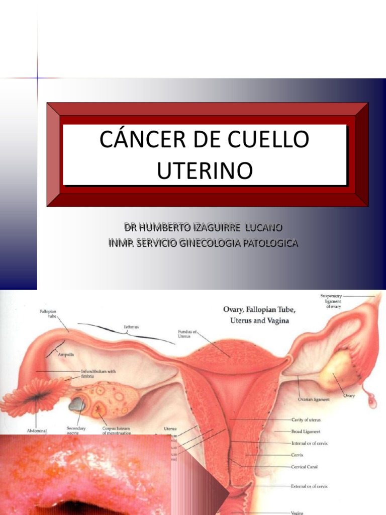 CA CERVIX | Cáncer de cuello uterino | Especialidades médicas