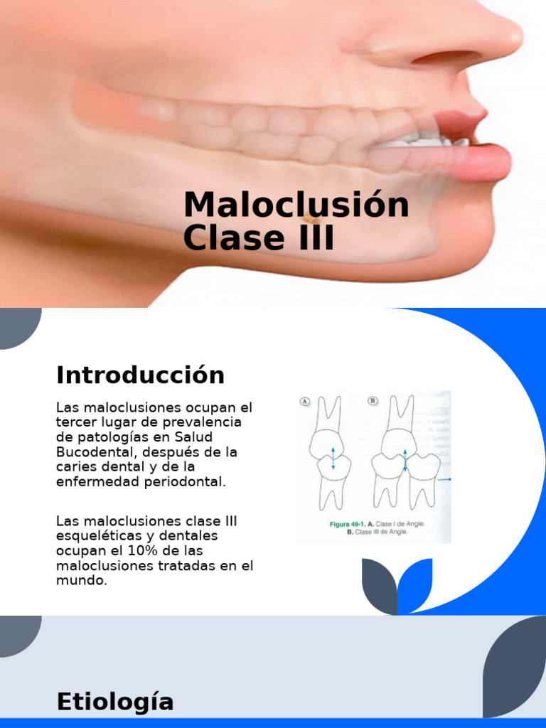 Maloclusión Clase III [Autosaved] | PDF | Ortodoncia | Ramas de Odontología