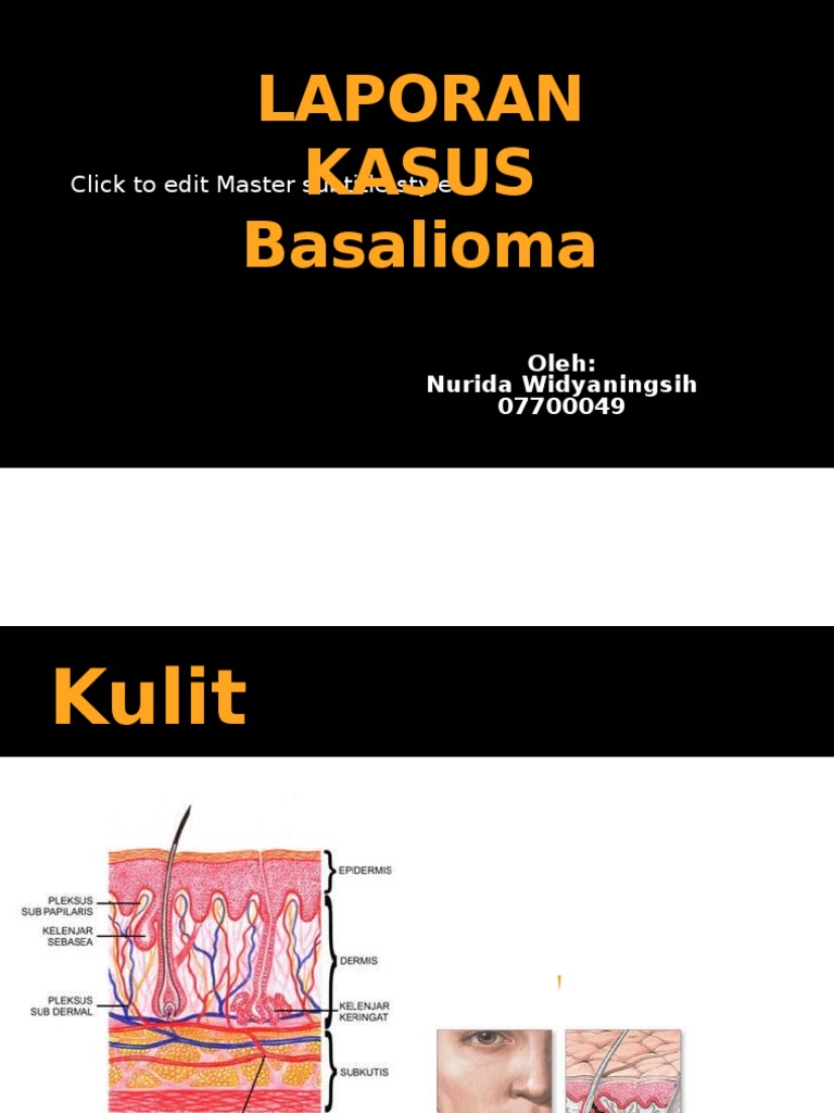 Laporan Kasus Basalioma Regio Oris | PDF