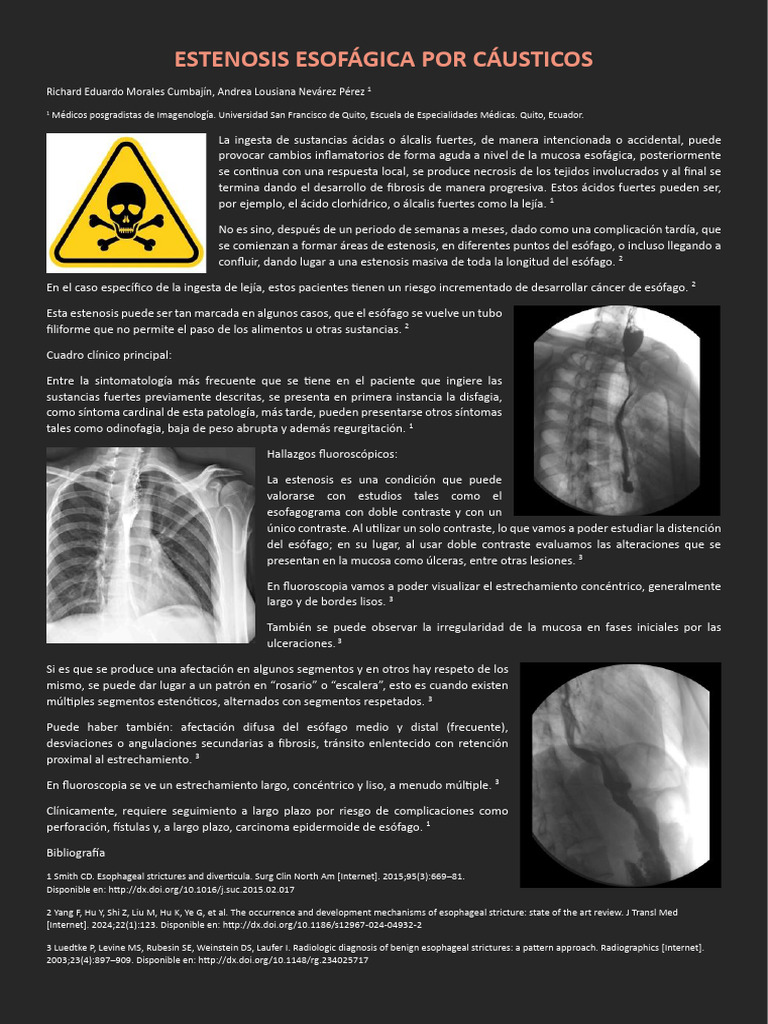 Estenosis esofágica por cáusticos | PDF | Esófago | Medicina CLINICA