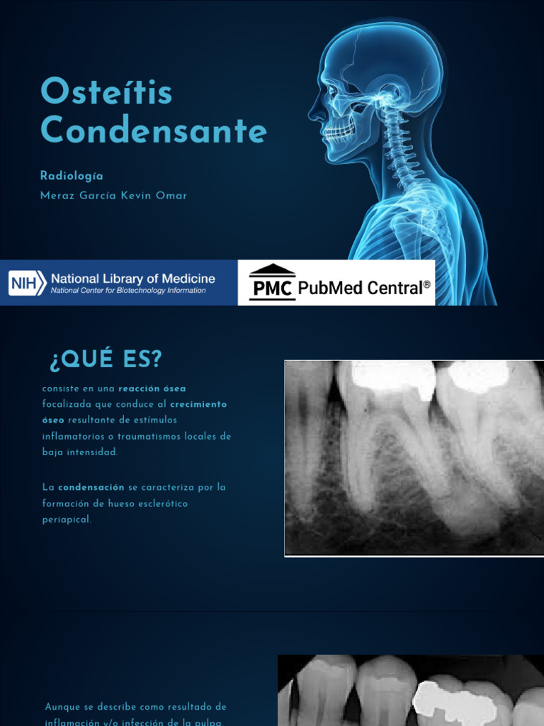 Osteitis condensante | PDF | Hueso | Medicina