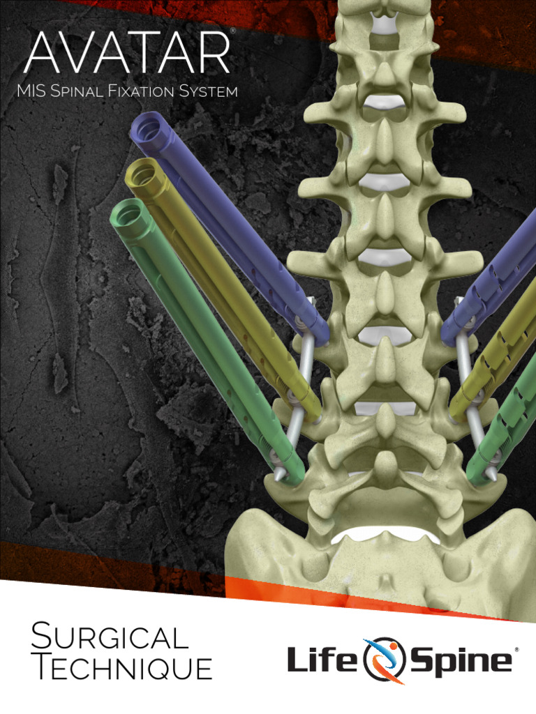 AVATAR® MIS Spinal Fixation Guide | PDF | Screw | Surgery