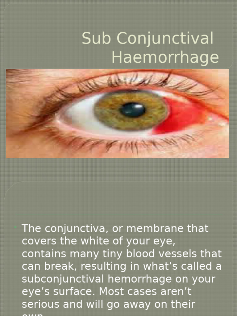 Sub Conjunctival Haemorrhage | PDF | Bleeding | Blood Vessel