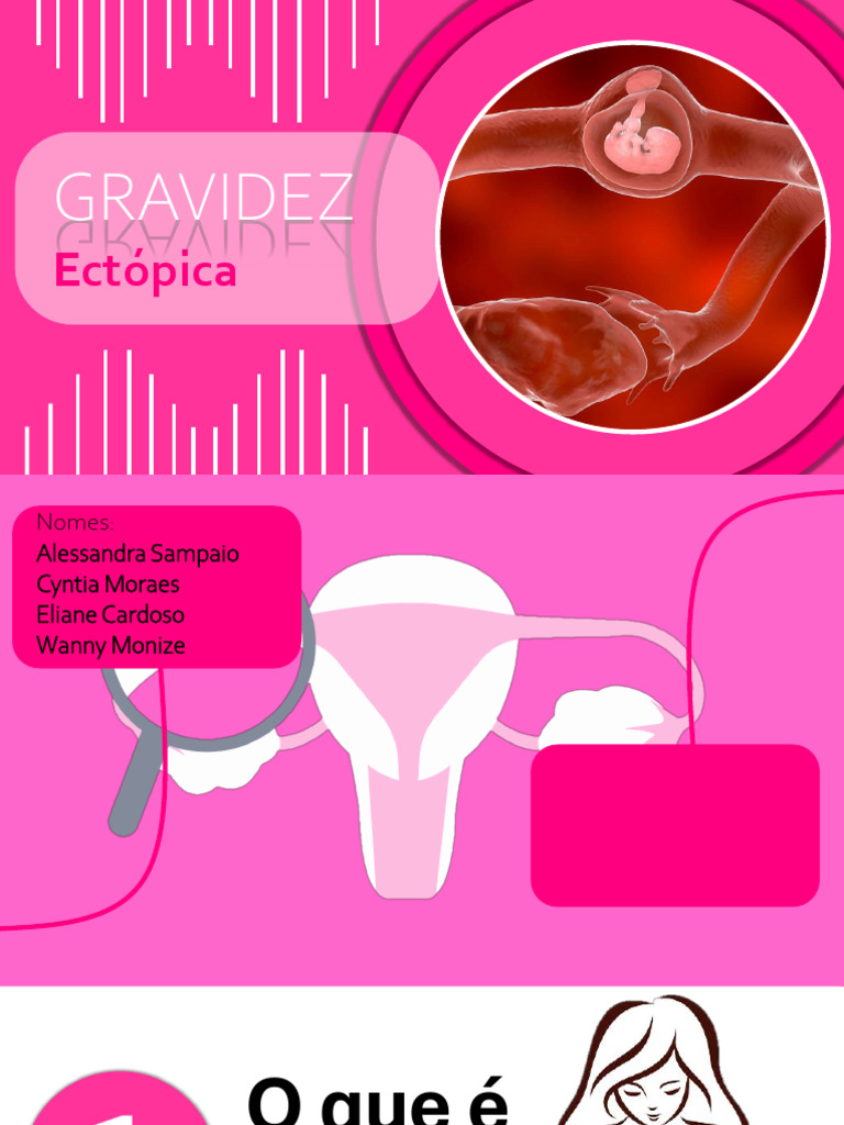 GRAVIDEZ ECTÓPICA - Editado | PDF | Gravidez | Remédio