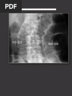 Signos radiológicos de neumoperitoneo | PDF | Abdomen | Hígado