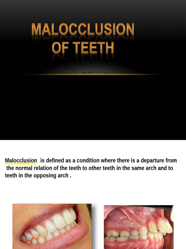 Understanding Malocclusion Causes and Types | PDF | Dental Anatomy | Mouth