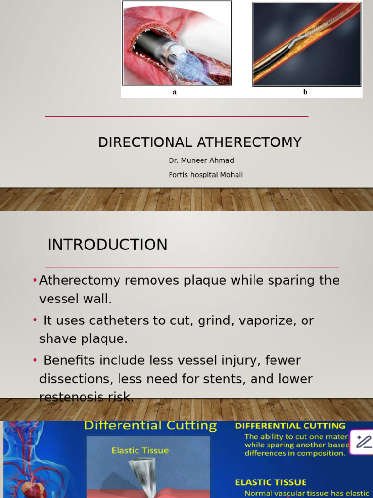 Directional Atherectomy Overview and Benefits | PDF | Atheroma | Stent