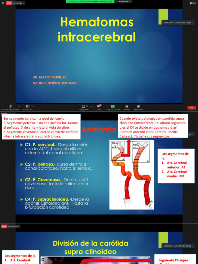 02. Hematoma Intracerebral (1)llllllllll | PDF | Cabeza y cuello ...