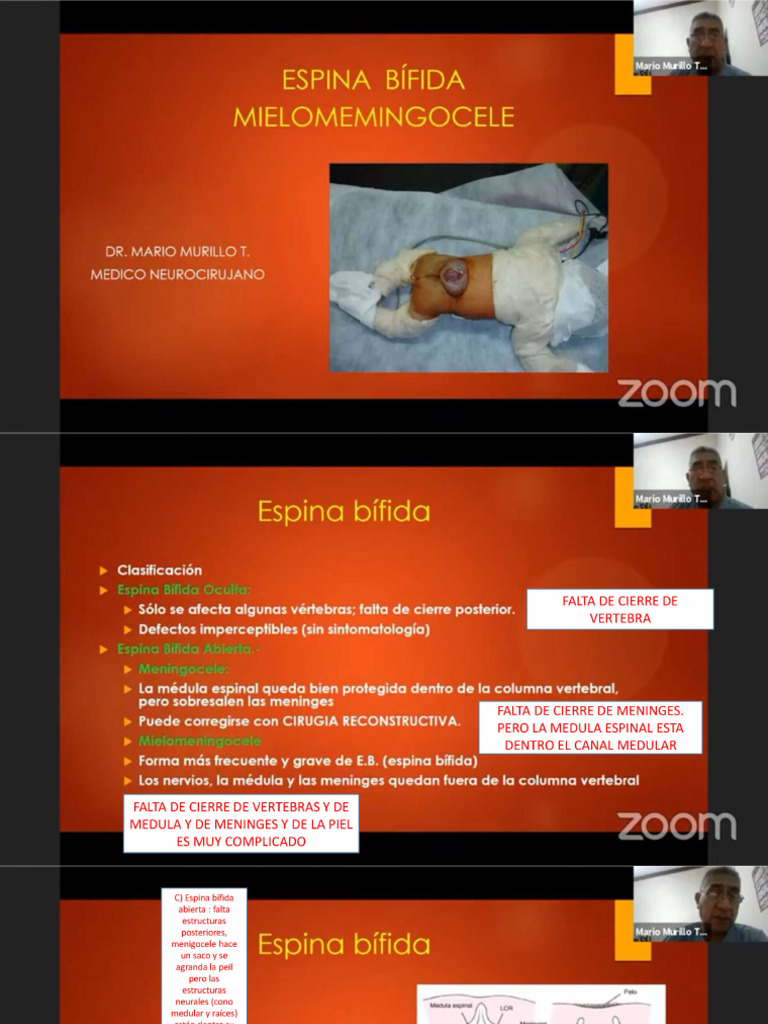 4. MIELOMENINGOCELE (1) eeeeeeeeeeeeeeee | PDF | Sistema nervioso ...