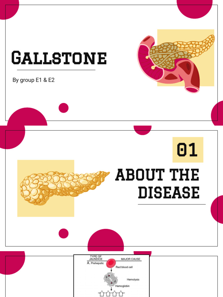 Understanding Gallstones: Types & Management | PDF | Gallbladder ...