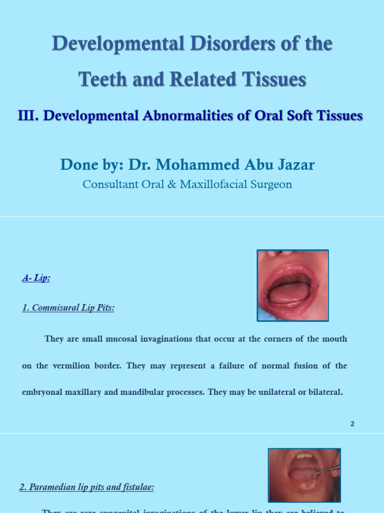 Developmental Abnormalities of Oral Soft Tissues | PDF | Tongue ...