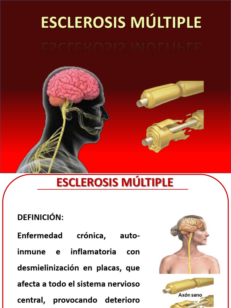 Esclerosis Múltiple: Definición y Tratamiento | PDF | Esclerosis ...