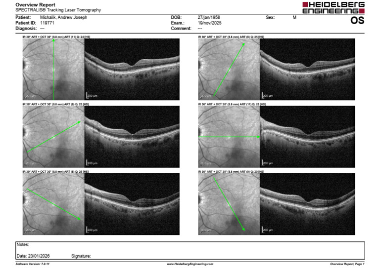 SPECTRALIS® Laser Tomography Report | PDF