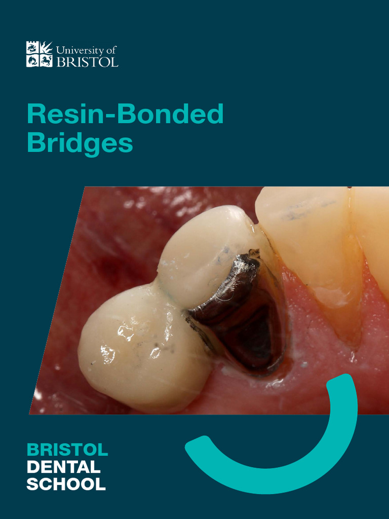 Resin-Bonded Bridges: Benefits & Process | PDF | Oral Hygiene | Dental ...