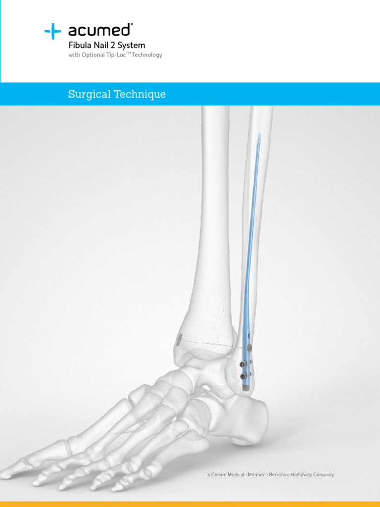 Acumed Surgical Technique en Fibula Nail 2 FNA10 02 E | PDF | Screw
