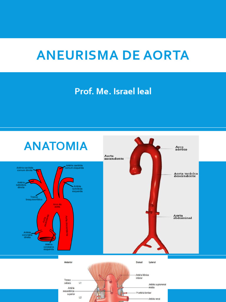 Aneurisma de Aorta | PDF