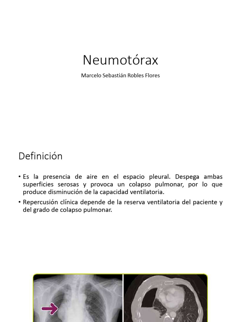 Neumotórax | PDF | Medicina | Enfermedades y trastornos humanos