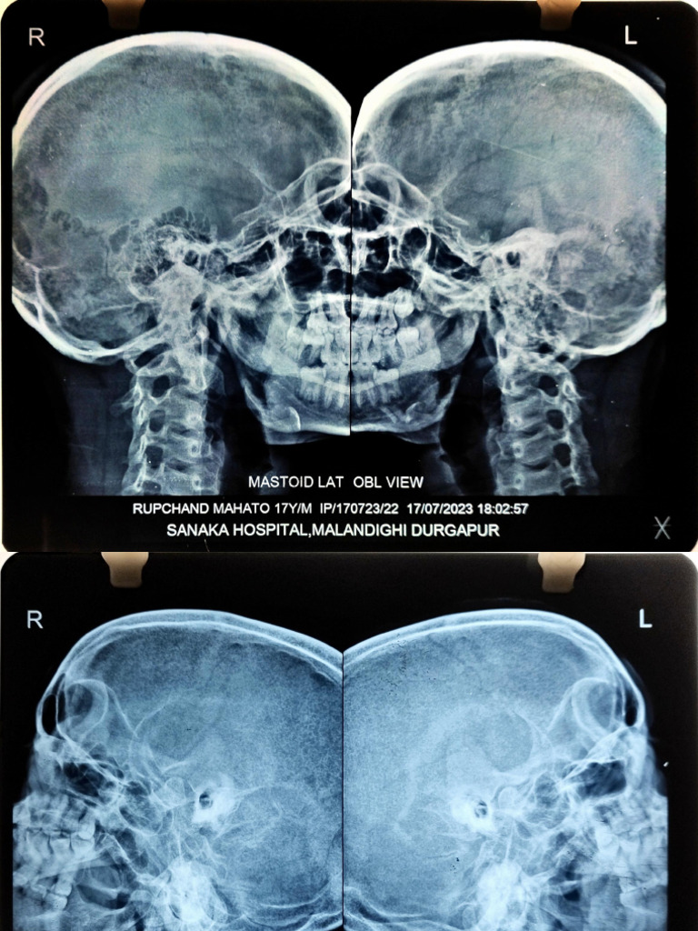 Mastoid Air Cells X Ray ENT | PDF | Otology | Skull