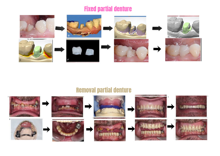 Fixed Partial Denture | PDF