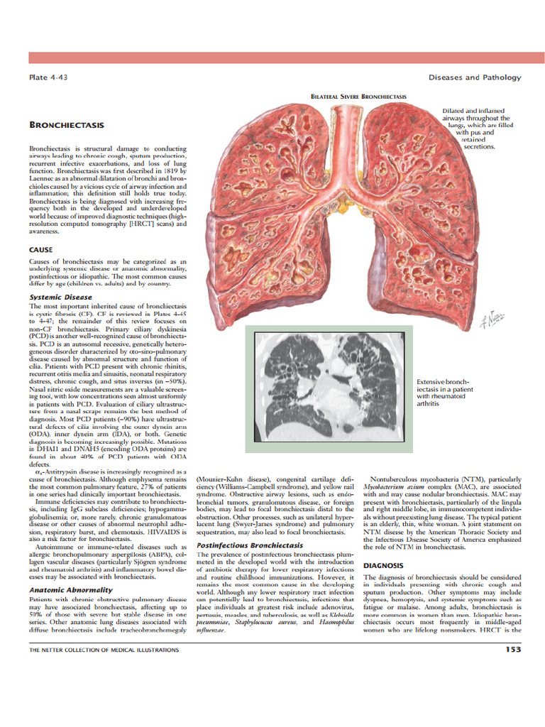 Bronquiectasia - Vol 3 The Netter Collection of Medical Illustrations ...