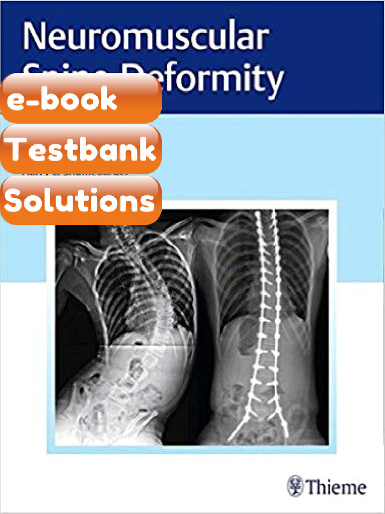 Neuromuscular Spine Deformity by Amer Samdani Peter O Newton Paul ...