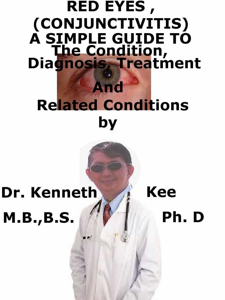 Red Eyes (Conjunctivitis), A Simple Guide To The Condition, Diagnosis ...