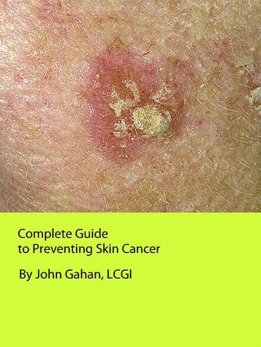 Complete Guide to Preventing Skin Cancer by John Gahan, LCGI - Ebook ...