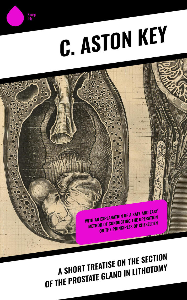A Short Treatise on the Section of the Prostate Gland in Lithotomy by C ...