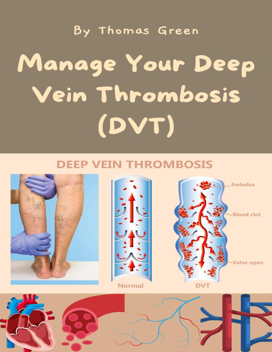Manage Your Deep Vein Thrombosis (DVT) by Thomas Green (Ebook) - Read ...